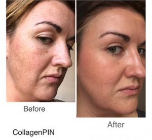 Collagen PIN Microneedling - La Jolla Dermatology