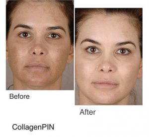 Collagen PIN Microneedling - La Jolla Dermatology