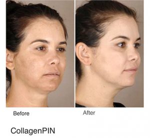 Collagen PIN Microneedling - La Jolla Dermatology