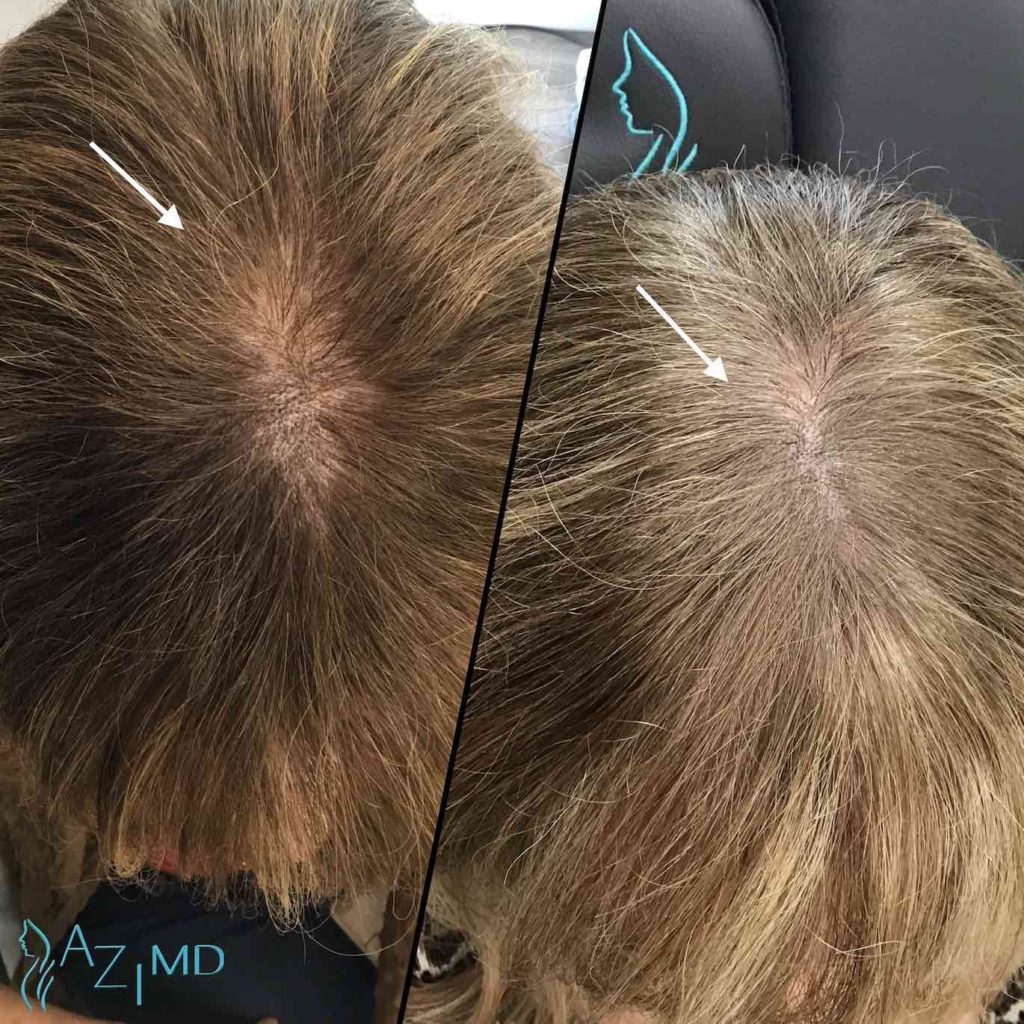 Scalp PRP - La Jolla Dermatology