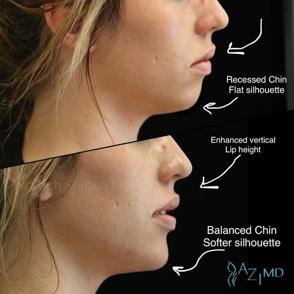 Non-surgical Chin augmentation - La Jolla Dermatology