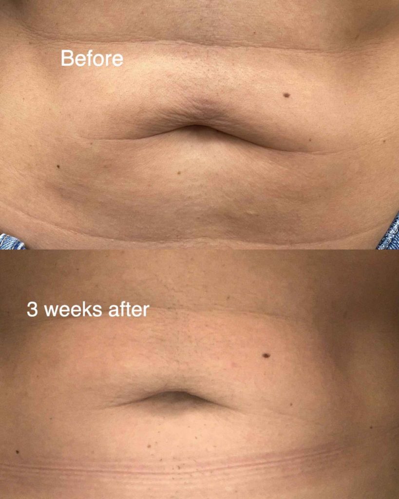 Thread Lift - La Jolla Dermatology