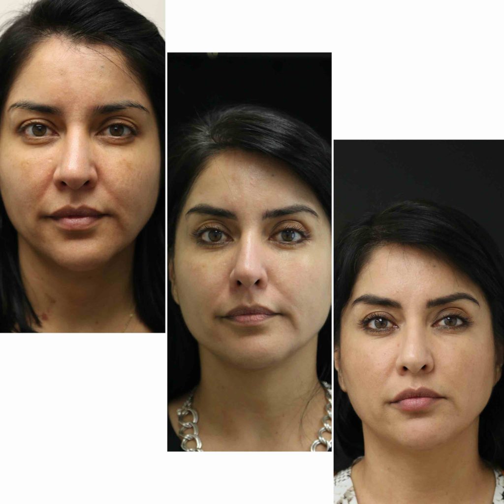 Collagen Pin Microneedling - La Jolla Dermatology