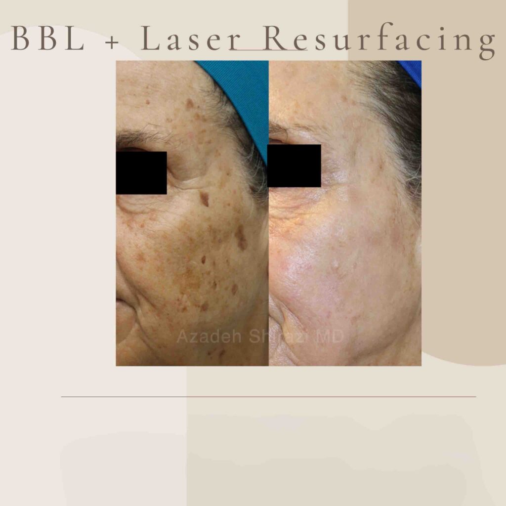 BBL Photorejuvenation - La Jolla Dermatology