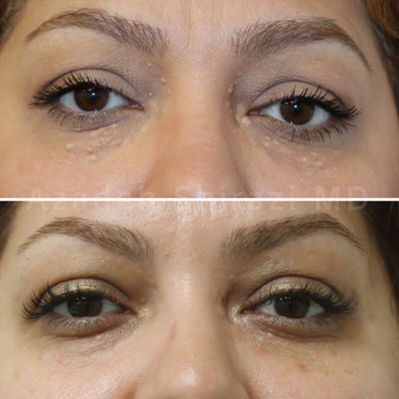 Skin Growth Removal - La Jolla Dermatology