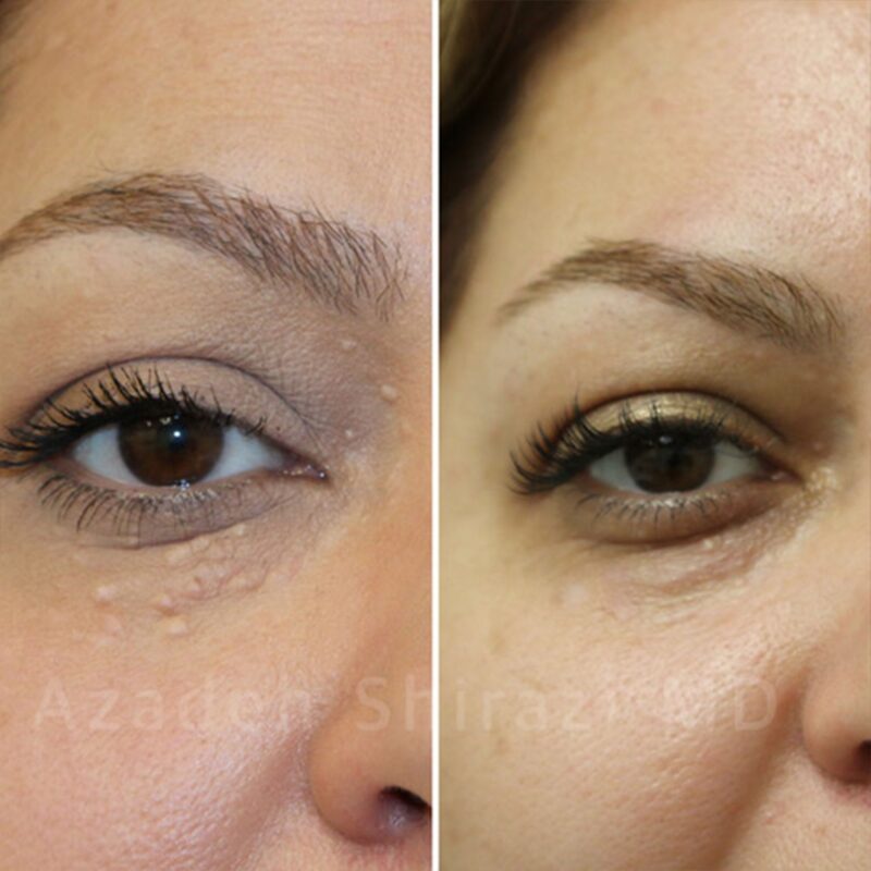 Skin Growth Removal - La Jolla Dermatology