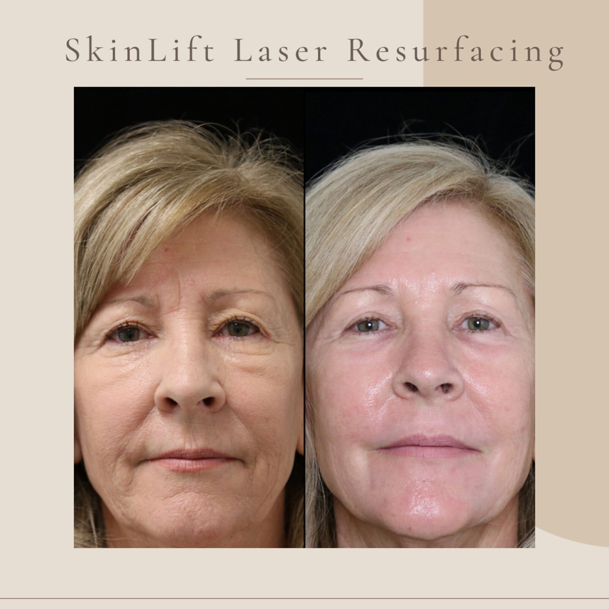 SkinLift Laser Rejuvenation - La Jolla Dermatology