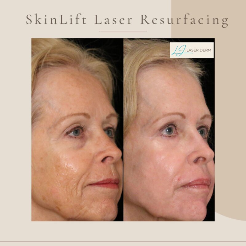 SkinLift Laser Rejuvenation - La Jolla Dermatology