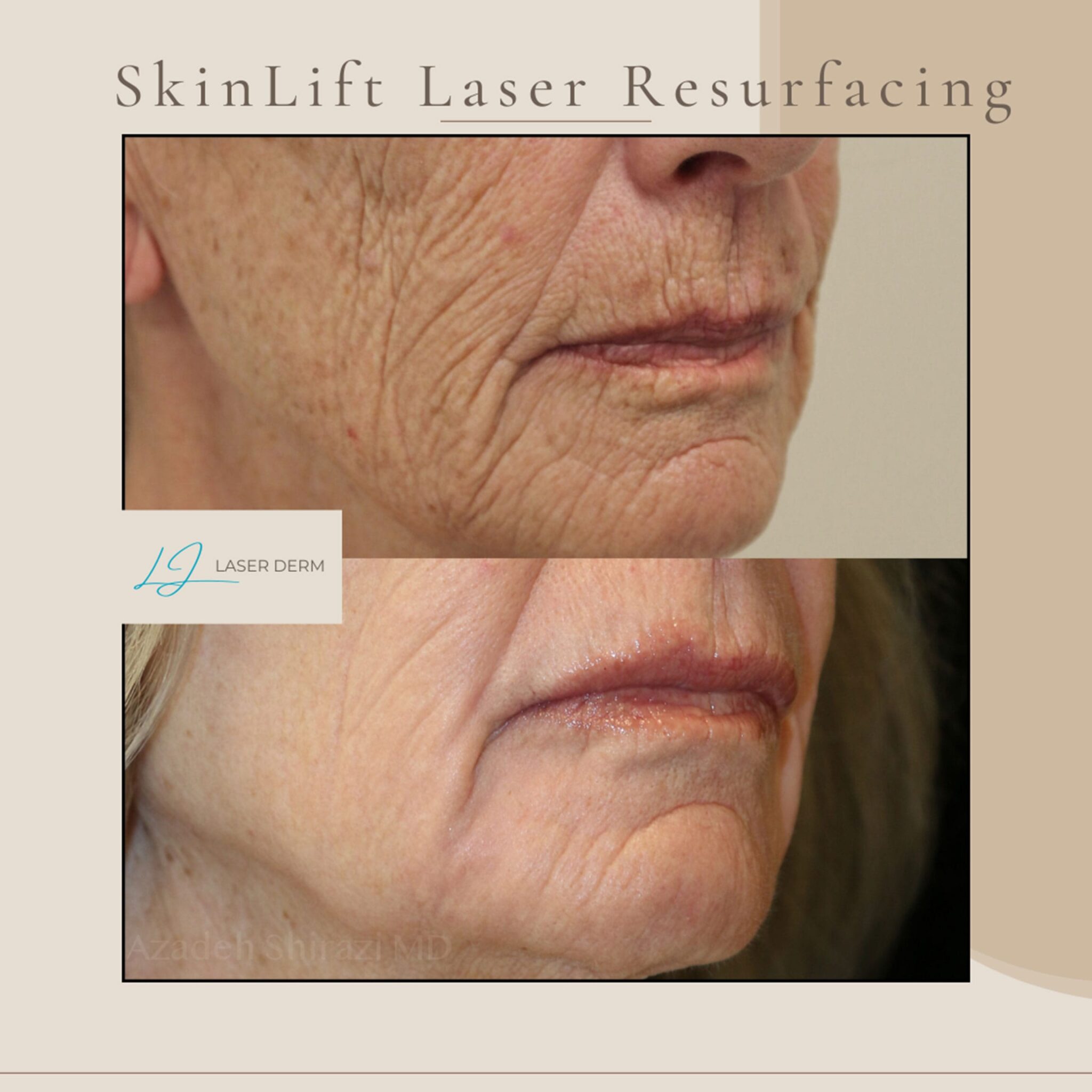 SkinLift Laser Rejuvenation - La Jolla Dermatology