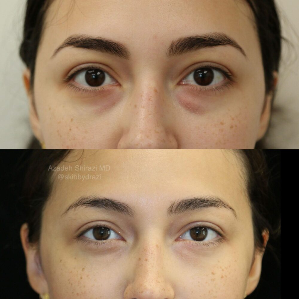 Non-Surgical Eye Bag Removal San Diego | Agnes RF
